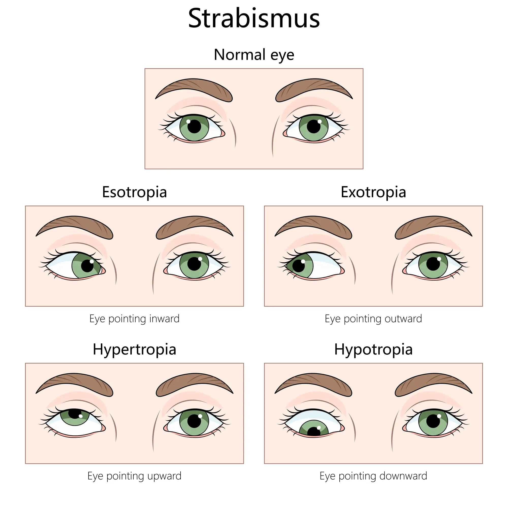 Strabismus Information and Treatment