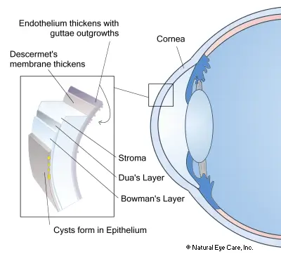 Fuchs' Dystrophy Information, Symptoms
